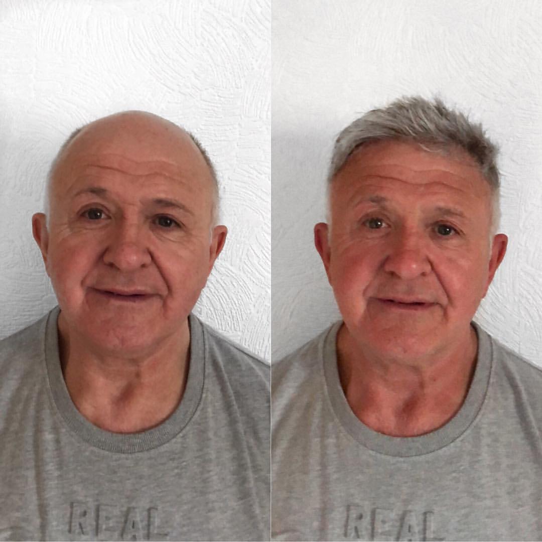 Thin Skin Hair Systems - Invisible - ReHair System